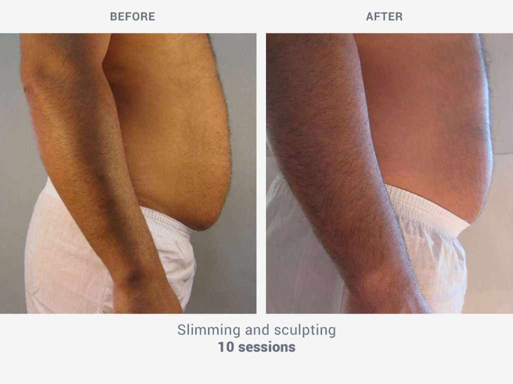 Kestos T2 - RÖS'S ESTÉTICA Integral body Thermo-stimulation